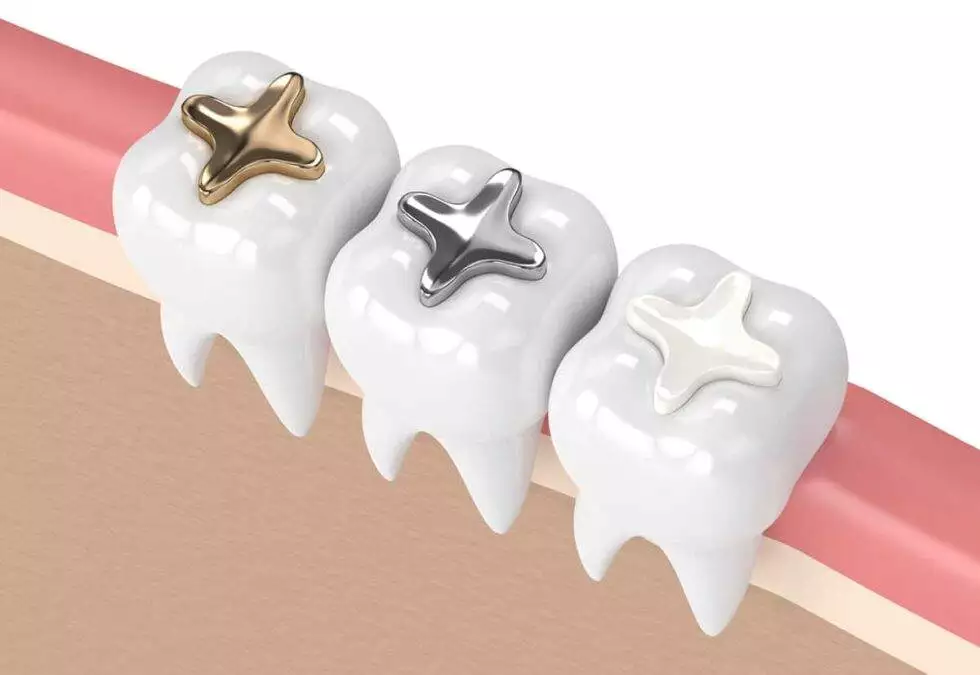 Types of Dental Fillings: Which One Is Right for You?